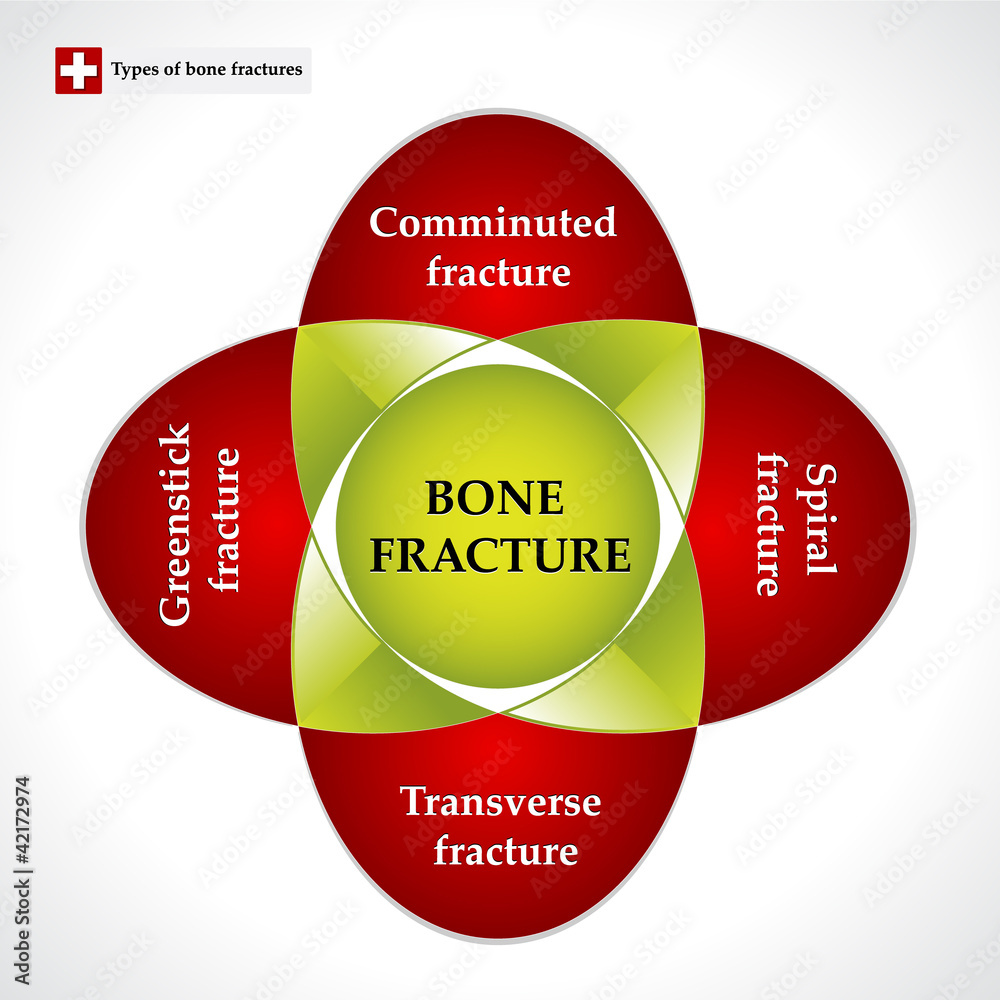 Types Of Bone Fractures Colorful Chart Stock Vector Adobe Stock Types Of Bone Fractures Colorful Chart Stock Vector Adobe Stock