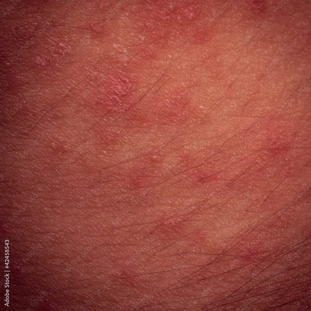 eczema atopic dermatitis symptom skin texture Stock Photo | Adobe Stock