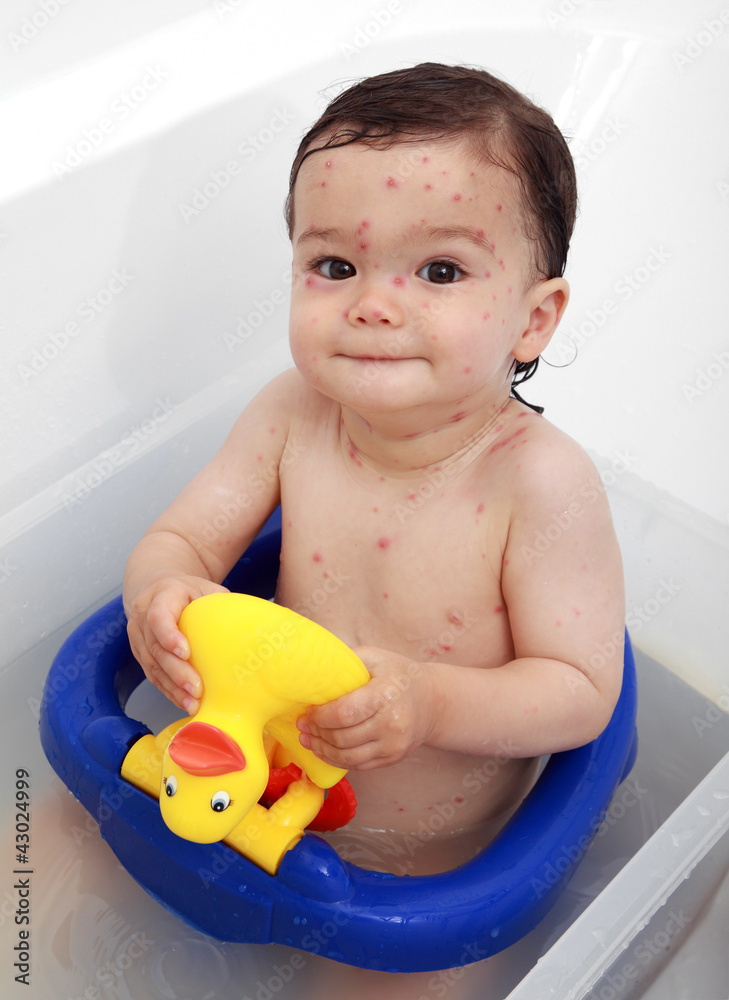 Baby relieving itchy rash in bath Stock Photo | Adobe Stock