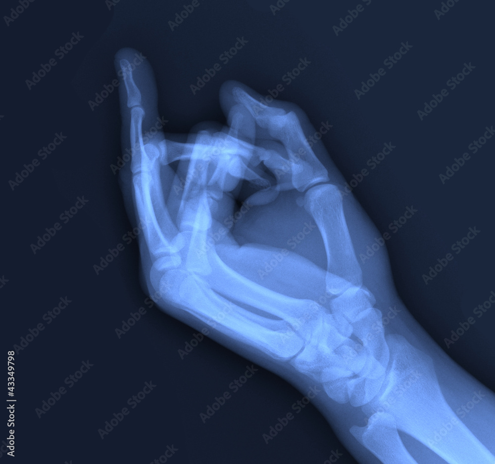 X-ray of the middle finger. Stock Illustration | Adobe Stock