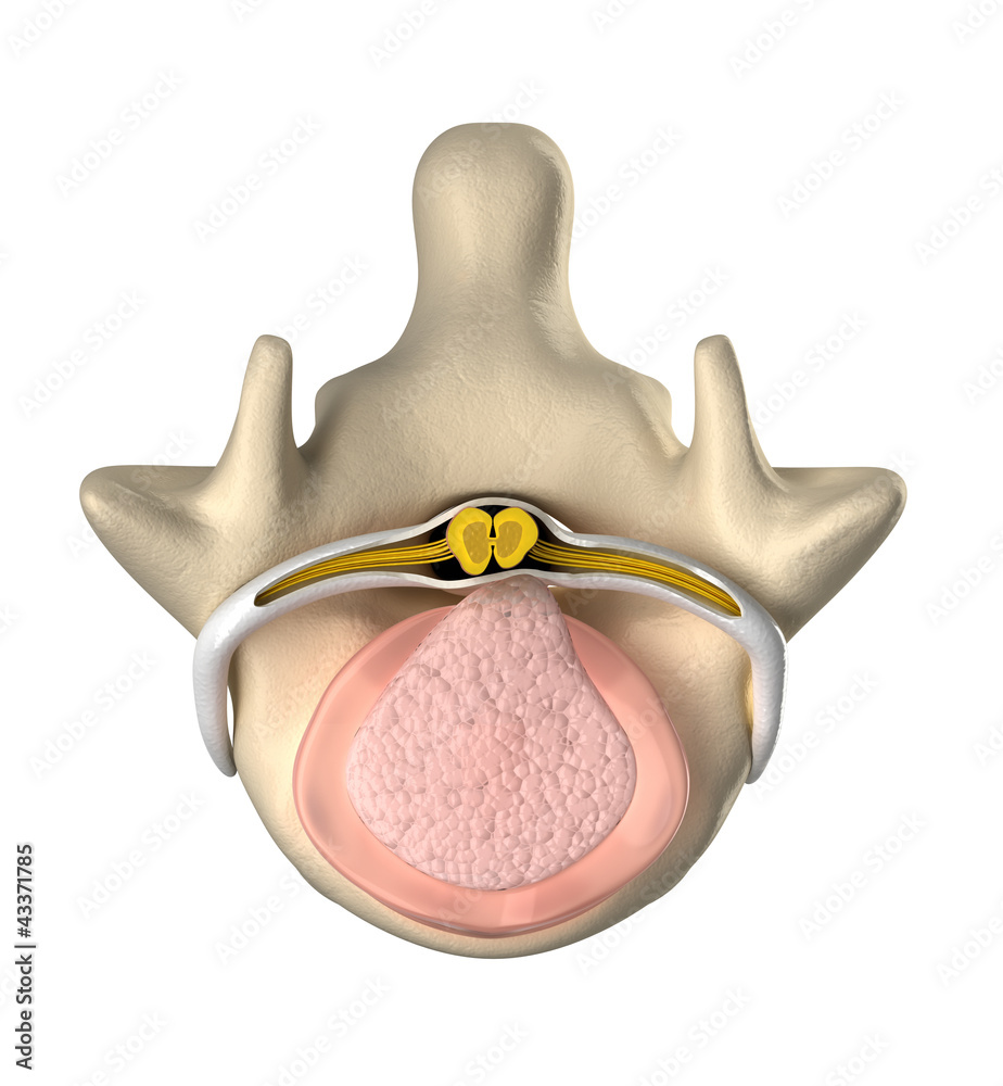 Póster Intervertebral disc with pressure on spinal cord top view ...