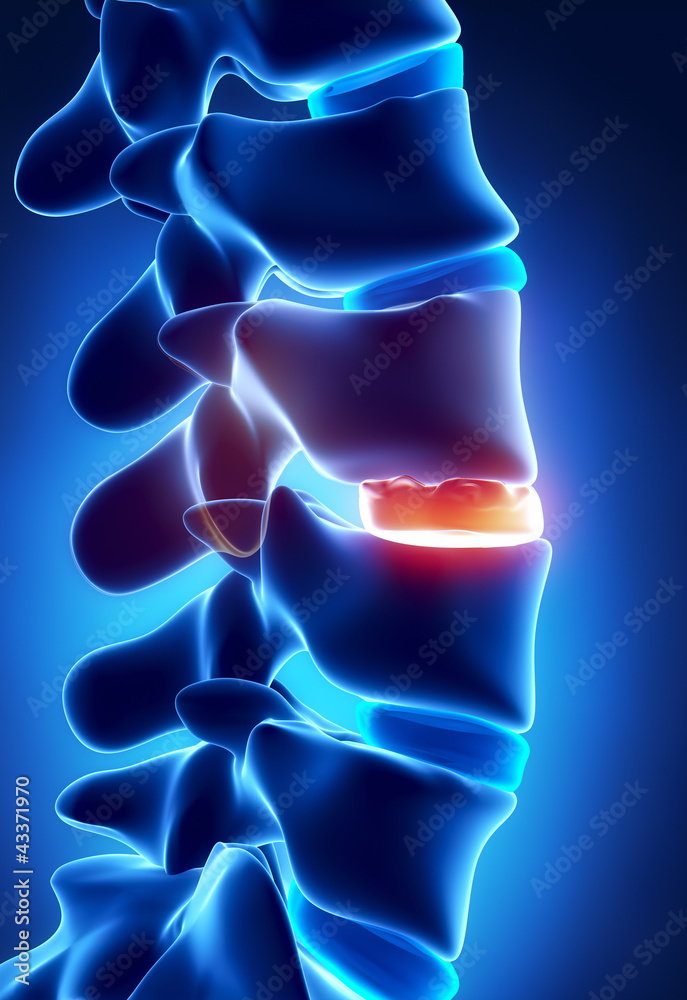 Disc degenarated by osteophyte formation in x-ray Stock Illustration ...