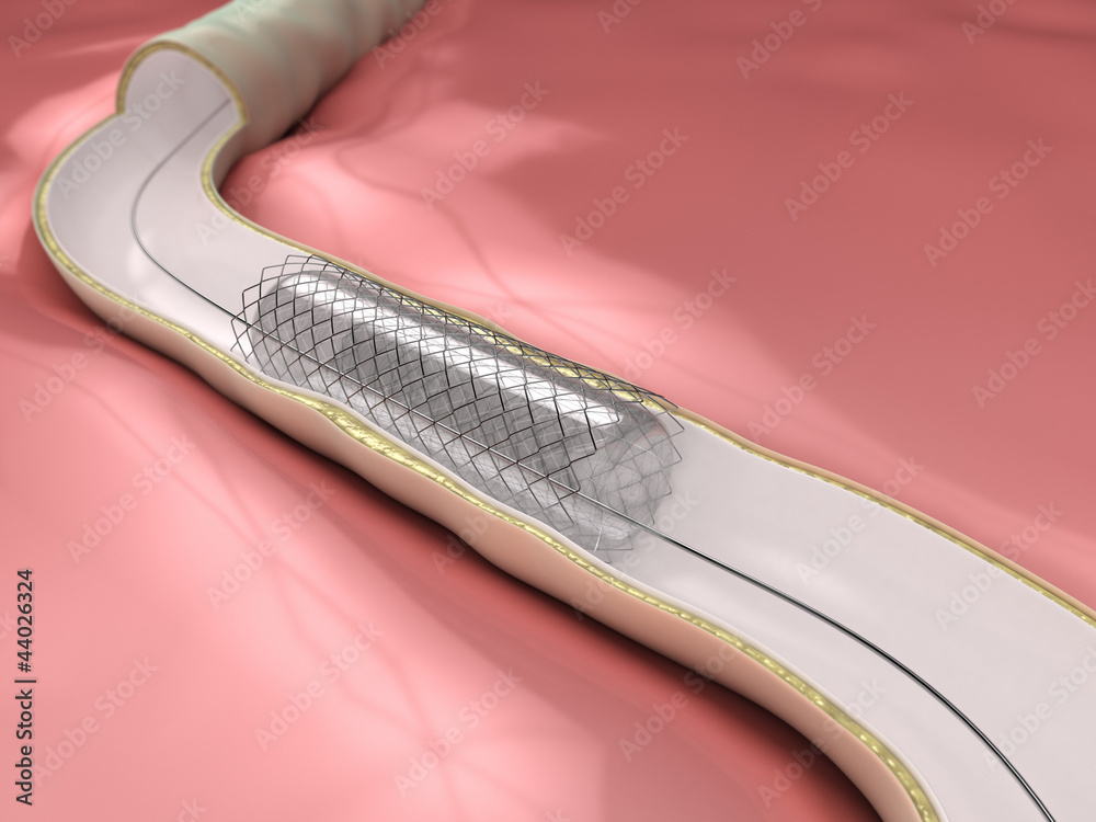Coronary procedure - ballon with stent opening lumen artery Stock Photo ...
