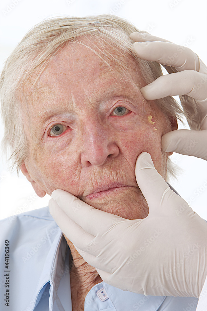 Dermatologie - Lésion cutanée Stock Photo | Adobe Stock