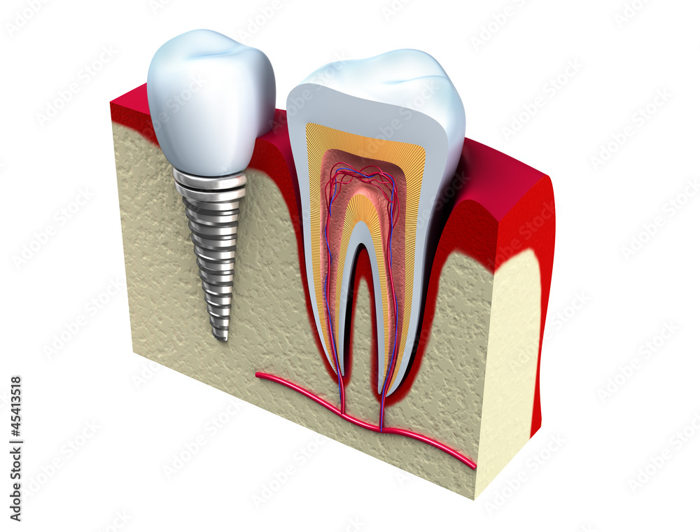 Anatomy of healthy teeth and dental implant in jaw bone. Stock ...