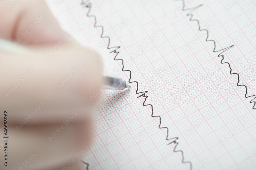 Analyzing of ECG. Hand with a pen on the ECG. Stock Photo | Adobe Stock