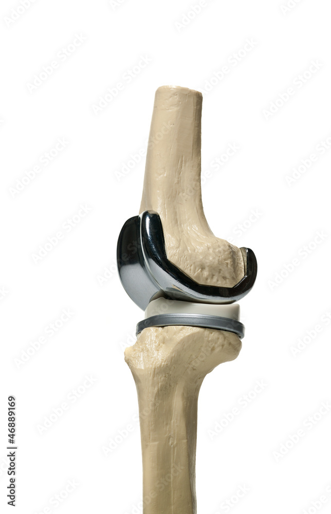 picture of an anatomic study model of an knee replacement Stock Photo ...