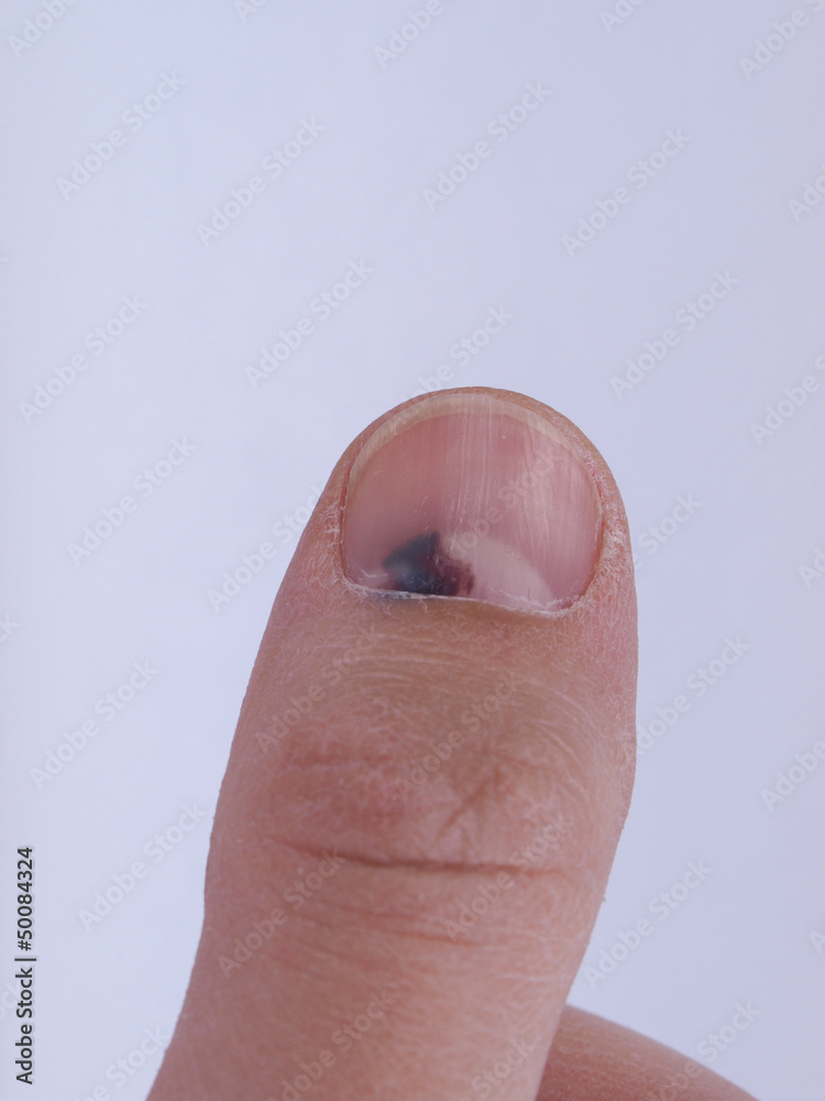Subungual hematoma under nail Stock Photo | Adobe Stock
