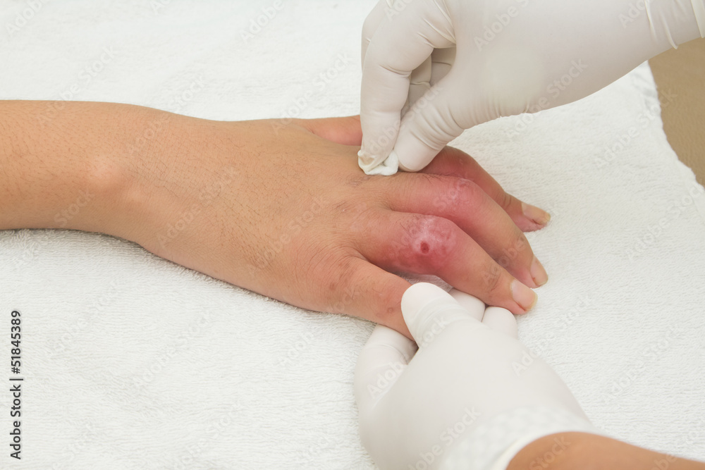 Hand Injury after car accident severed closed fracture 2-4 fin Stock ...