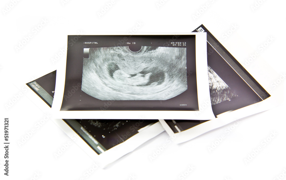 12 weeks baby ultrasound Image Stock Photo | Adobe Stock