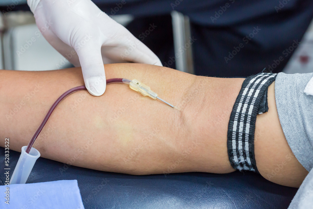 A large bore needle is inserted for blood donation Stock Photo | Adobe ...