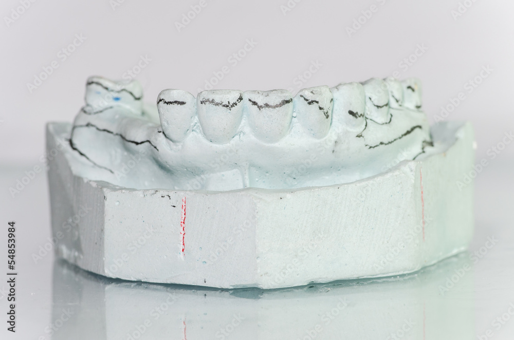 Dental Cast with Kennedy Class III mod I and Survey Line Stock Photo ...