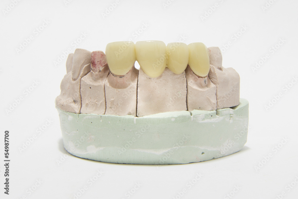 All ceramic highly aesthetic dental bridge and crown on gypsum m Stock ...