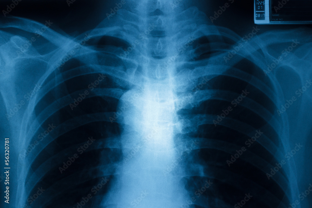 Chest x-ray Stock Photo | Adobe Stock