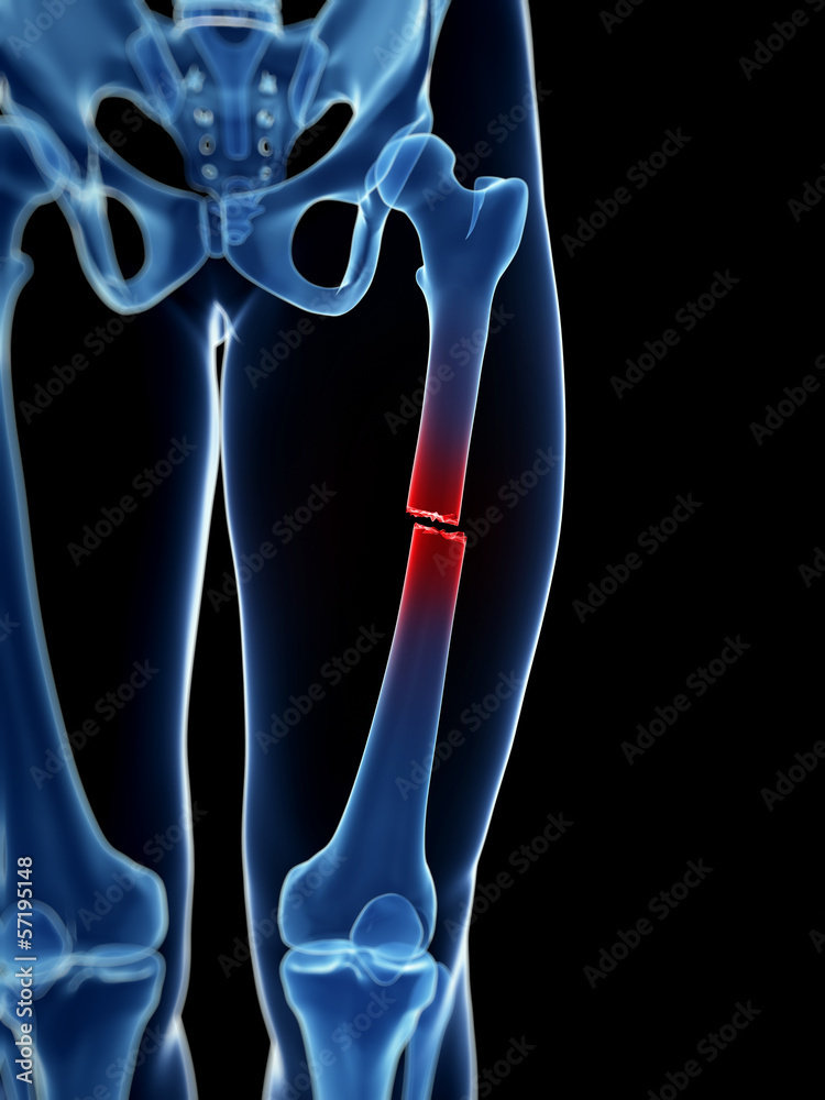 medical illustration of a broken leg bone Stock Illustration | Adobe Stock