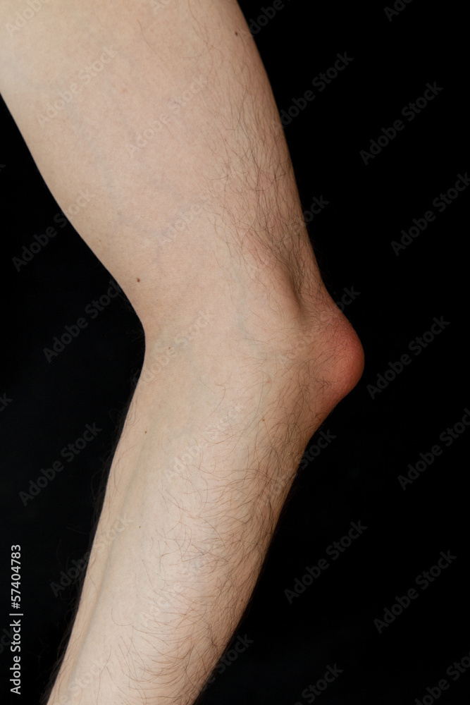 Olecranon bursitis, also known as student’s elbow Stock Photo | Adobe Stock