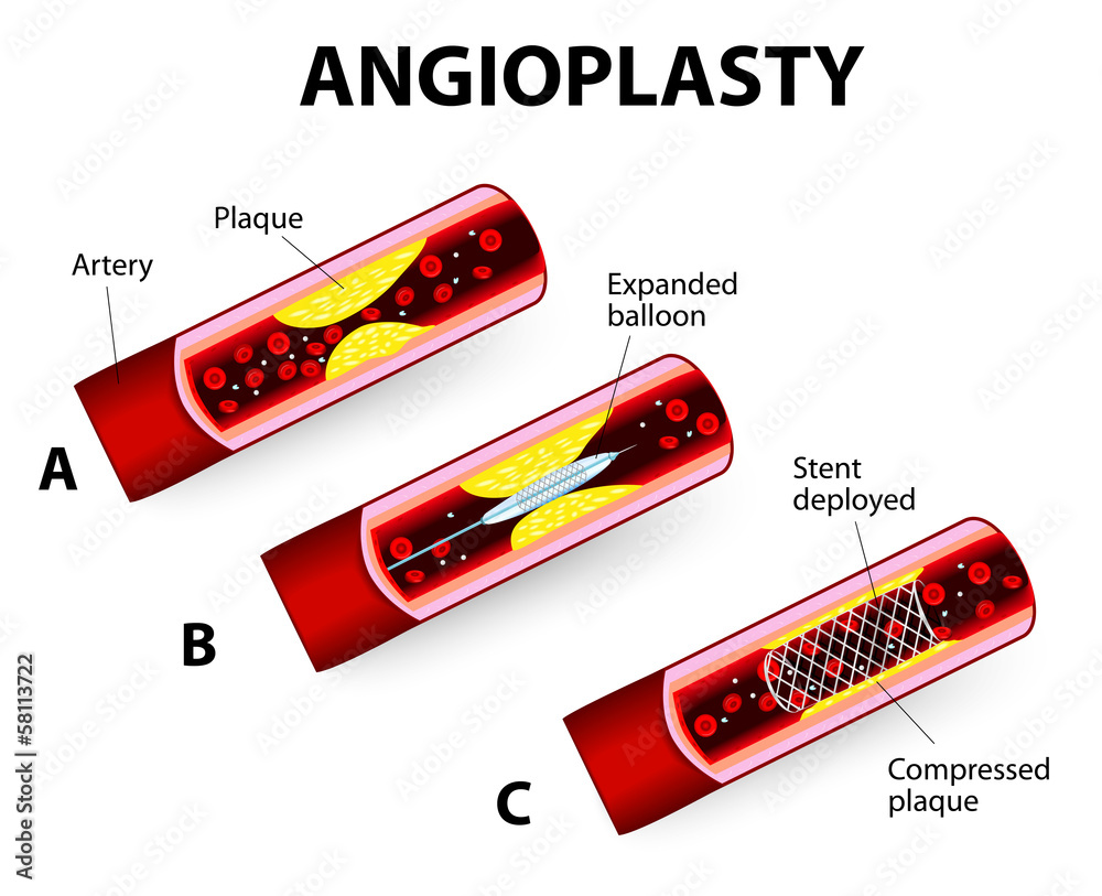 Coronary Balloon Angioplasty. Vector diagram Stock Vector | Adobe Stock