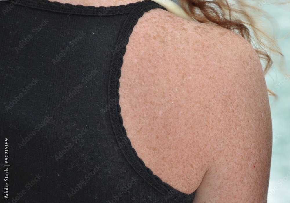Freckles in shoulder Stock Photo | Adobe Stock