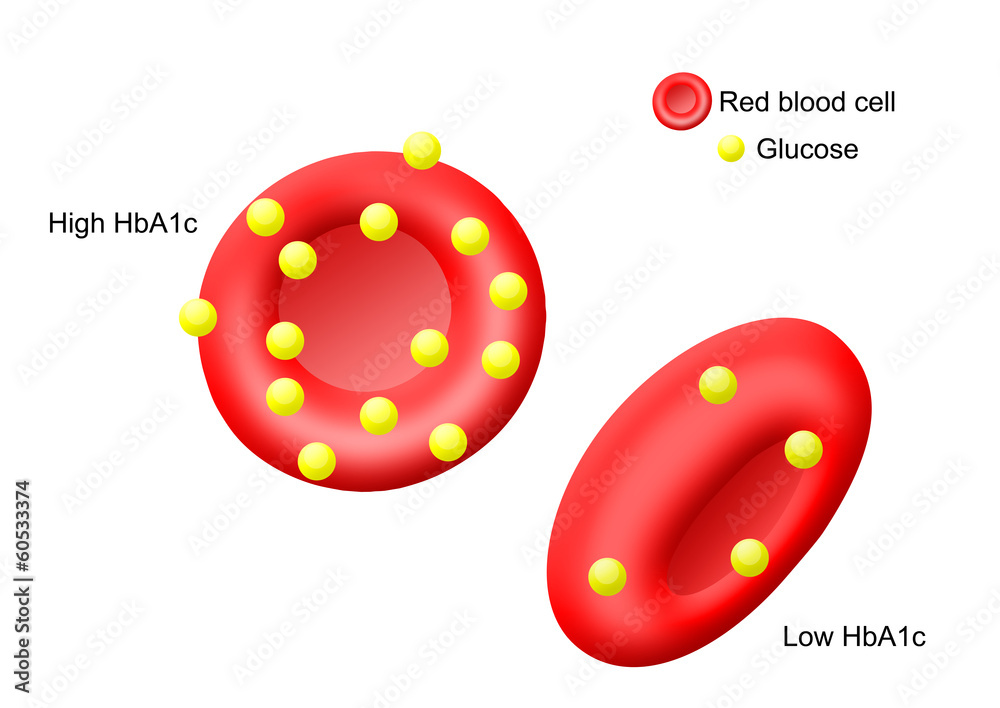 Comparison of high and low HbA1c blood - diabetes Stock Illustration ...