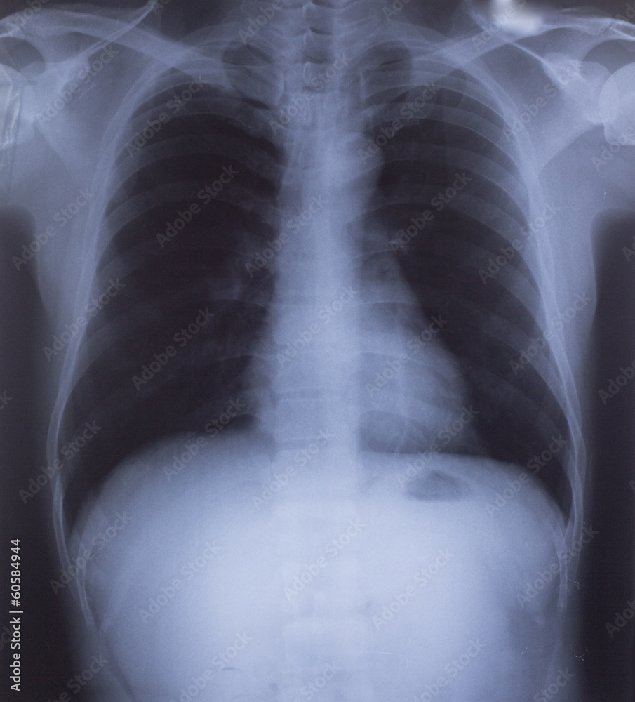 X-Ray Image Of Human Chest for a medical diagnosis Stock Photo | Adobe ...