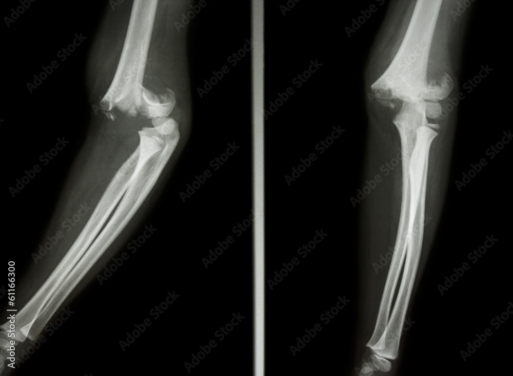 Supracondylar humerus fracture Stock Photo | Adobe Stock