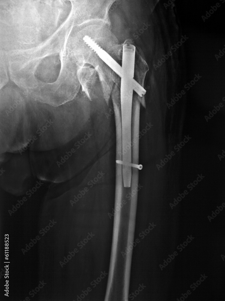 Foto de Radiografia del femore. Frattura do Stock | Adobe Stock