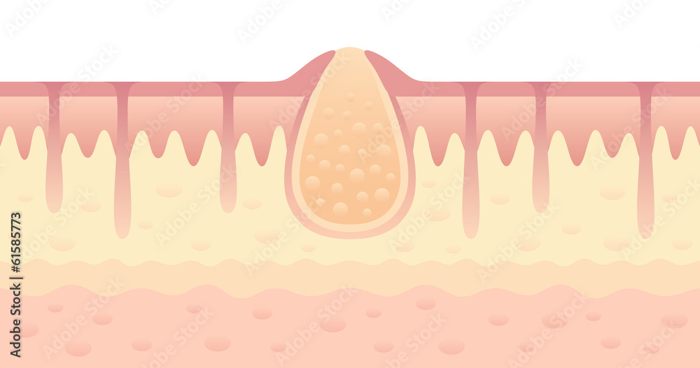 Pimple on skin Stock Vector | Adobe Stock