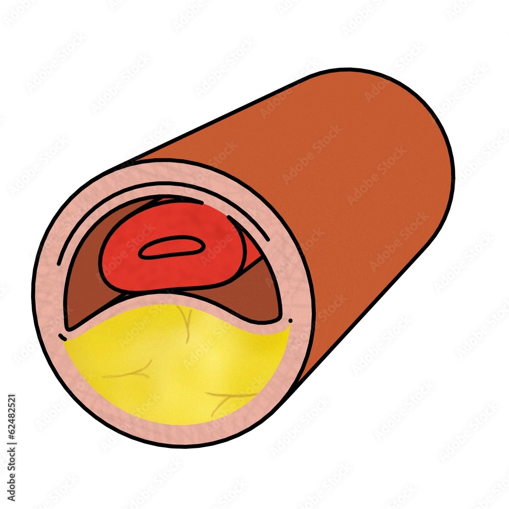 cartoon image of blood vessel with cholesterol Stock Photo | Adobe Stock