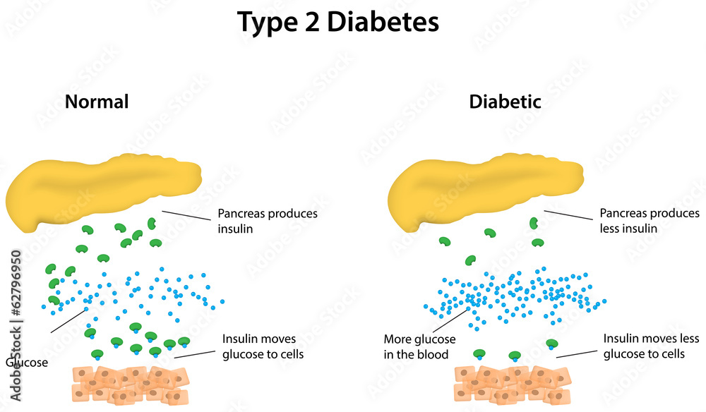 Type 2 Diabetes Labeled Diagram Stock Vector | Adobe Stock