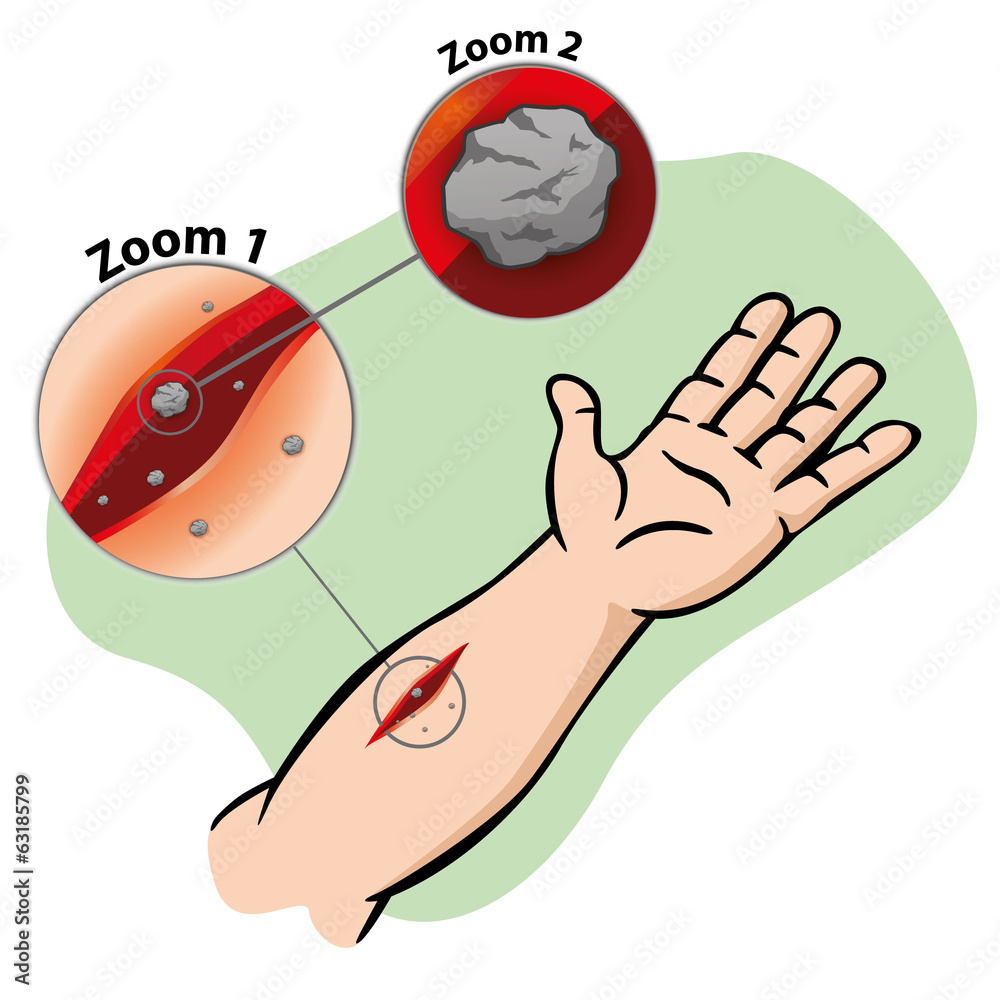 First Aid wound with foreign body Stock Vector | Adobe Stock