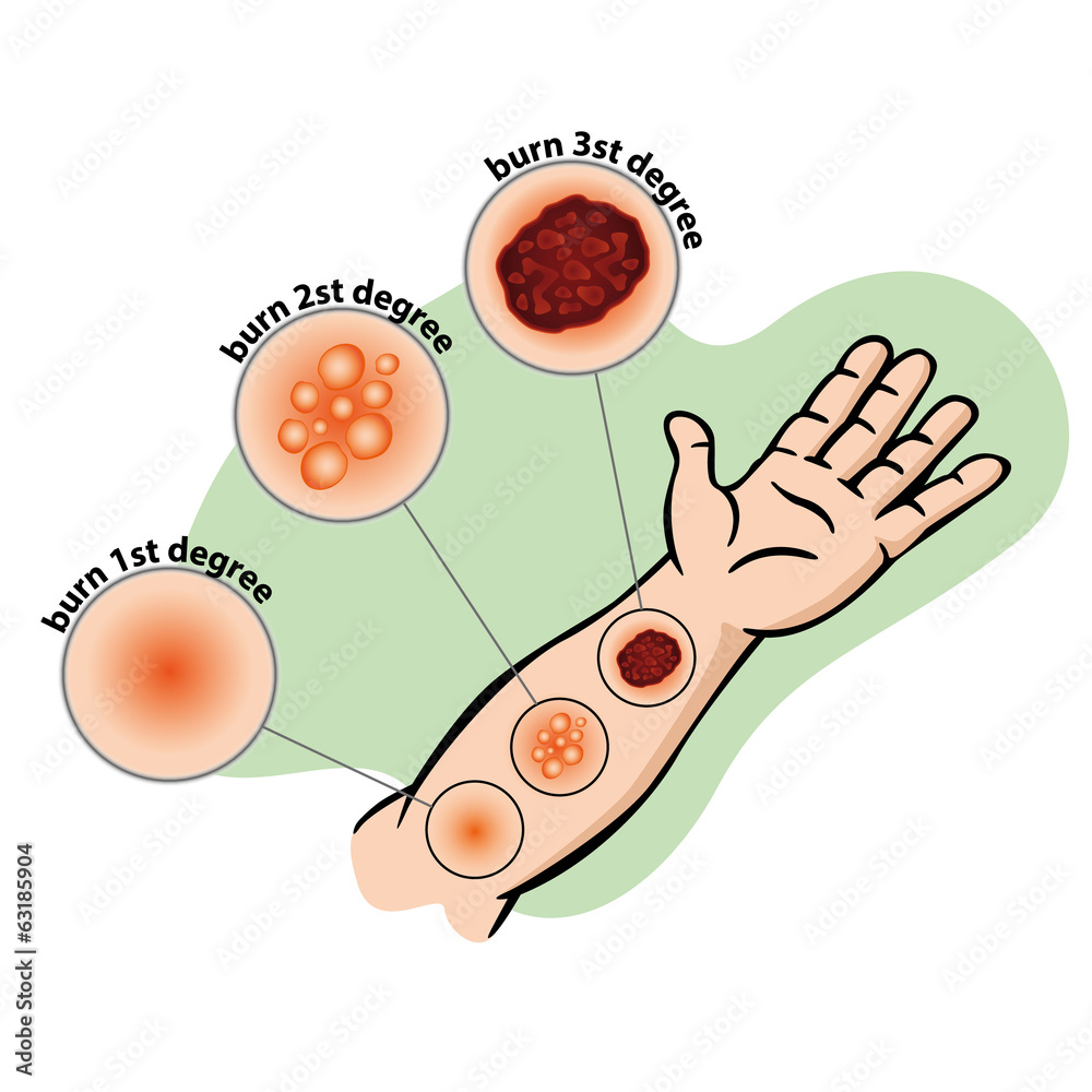 3rd Degree Burn Hot Water