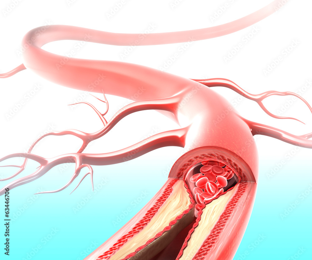 Anatomy of Atherosclerosis plaque Stock Illustration | Adobe Stock