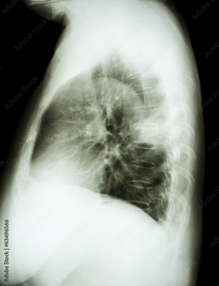 X-ray chest lateral of lung cancer patient Stock Photo | Adobe Stock