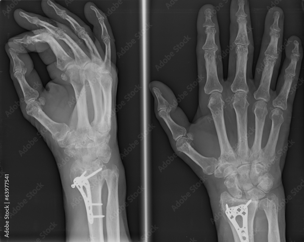 Xray of epiphysial radial fracture reduced Stock Photo | Adobe Stock