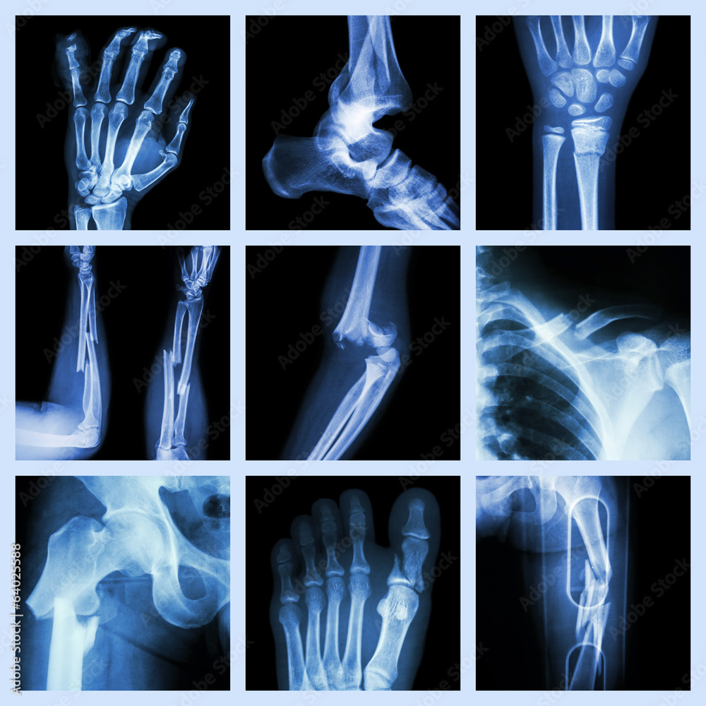 Collection of bone fracture Stock Photo | Adobe Stock