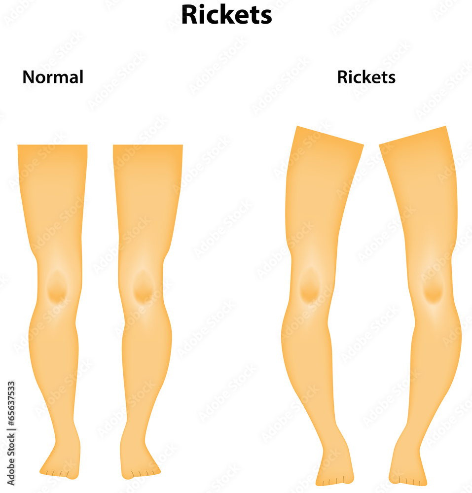 Rickets Stock Illustration | Adobe Stock