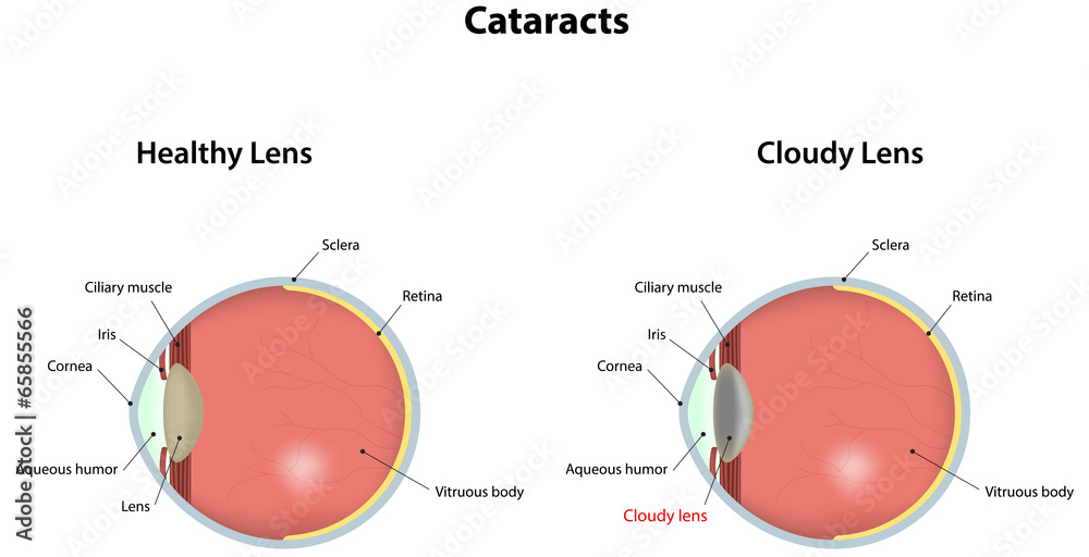 Cataracts Stock Illustration | Adobe Stock