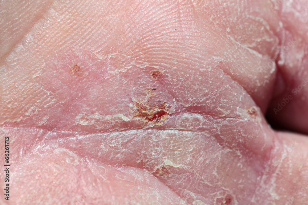 Neurodermitis Detail Stock-Foto | Adobe Stock