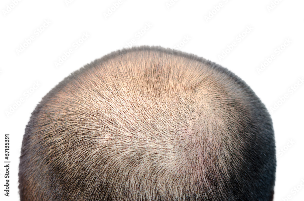 bald head Stock Photo | Adobe Stock