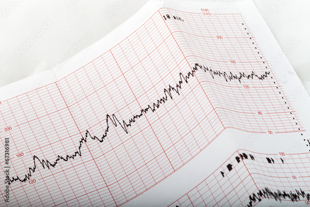 ecg graph, electrocardiogram ekg Stock Photo | Adobe Stock
