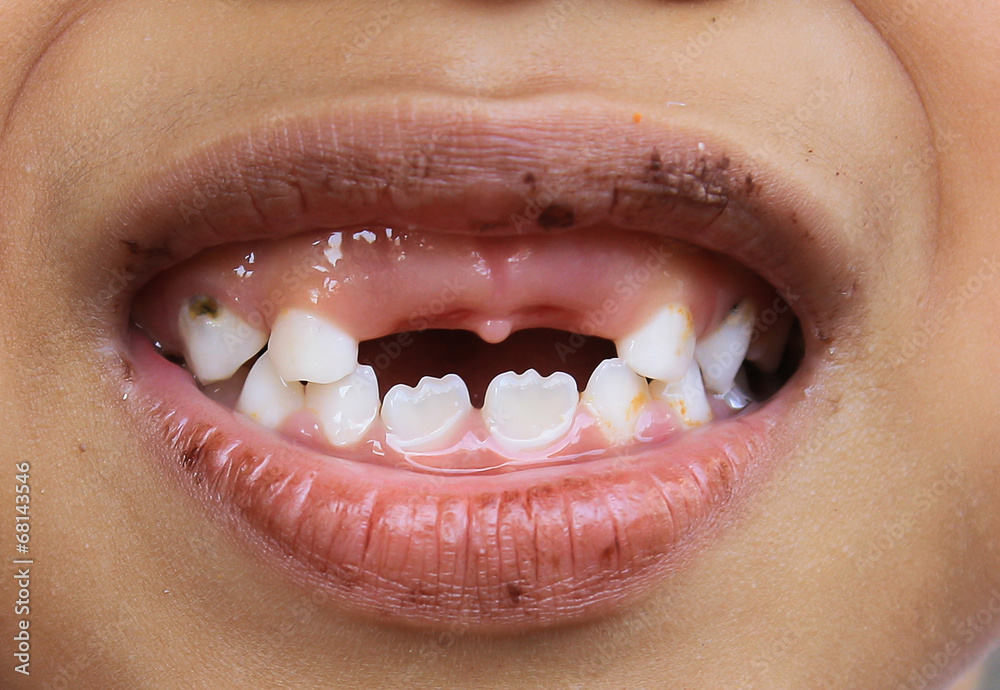 Kid With Broken Teeth