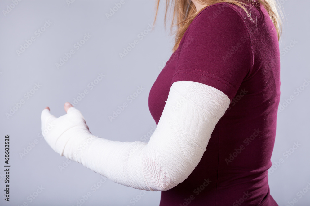 Broken arm Stock Photo | Adobe Stock