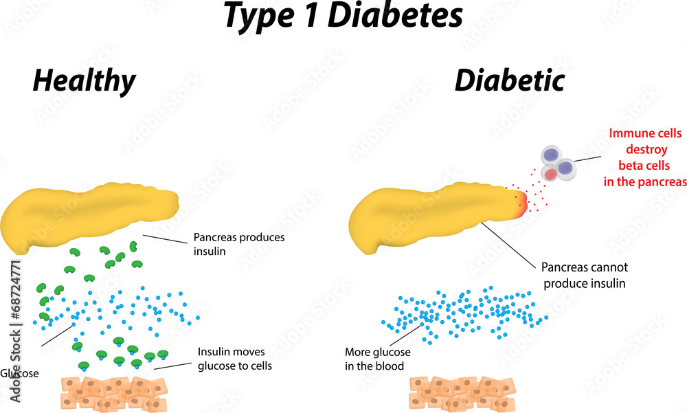 Type 1 Diabetes Labeled Diagram Stock Illustration | Adobe Stock