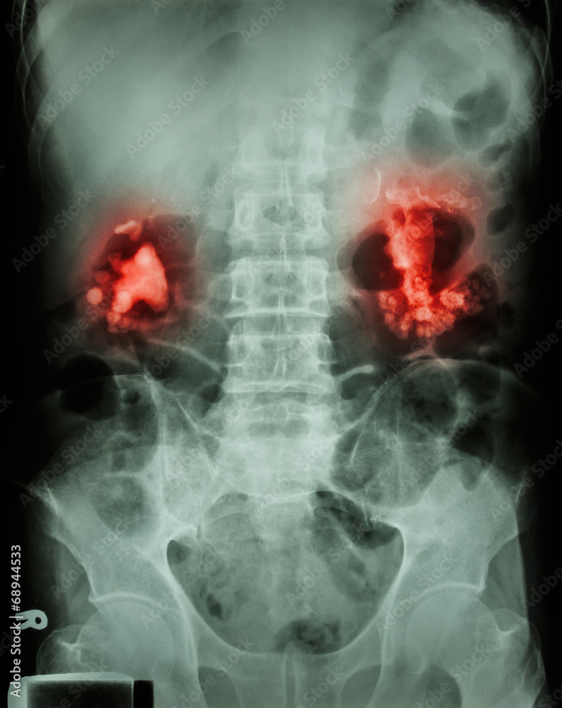 Bilateral renal calculi(staghorn) (Kidney stones) Stock Photo | Adobe Stock