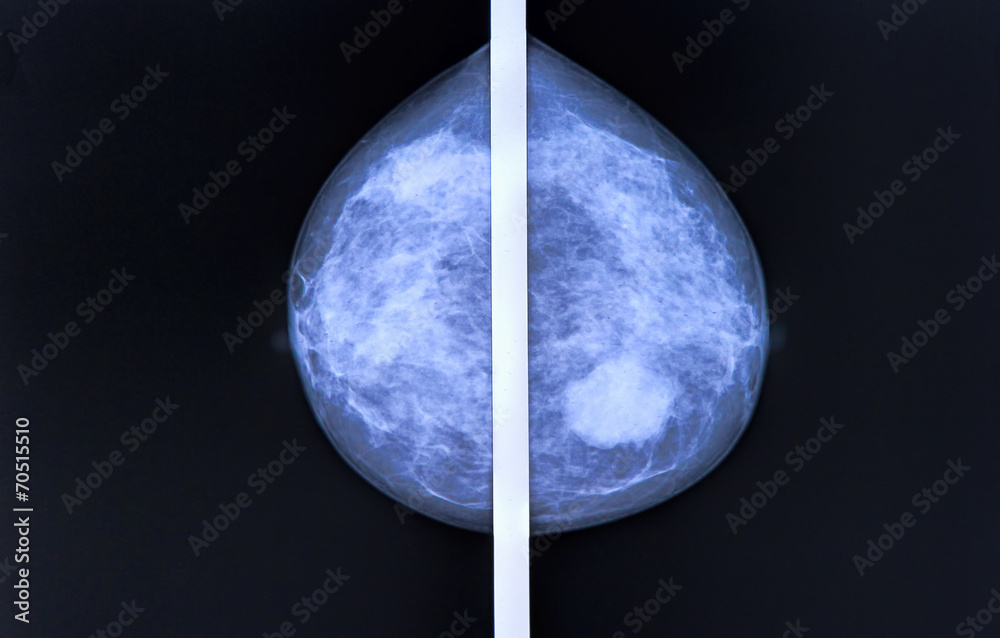 mammography Stock Photo | Adobe Stock