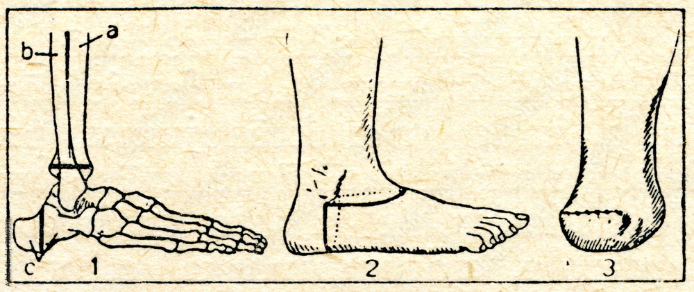 Pirogov's amputation (Boyd's amputation) Stock Photo | Adobe Stock