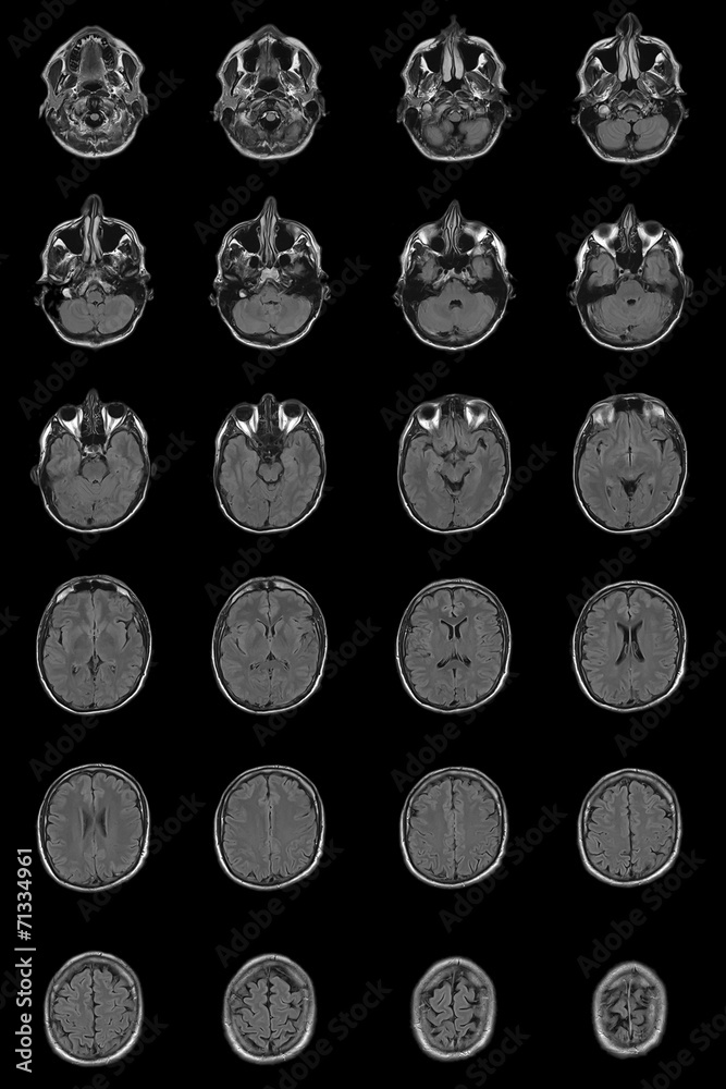 Healthy Human Brain Mri