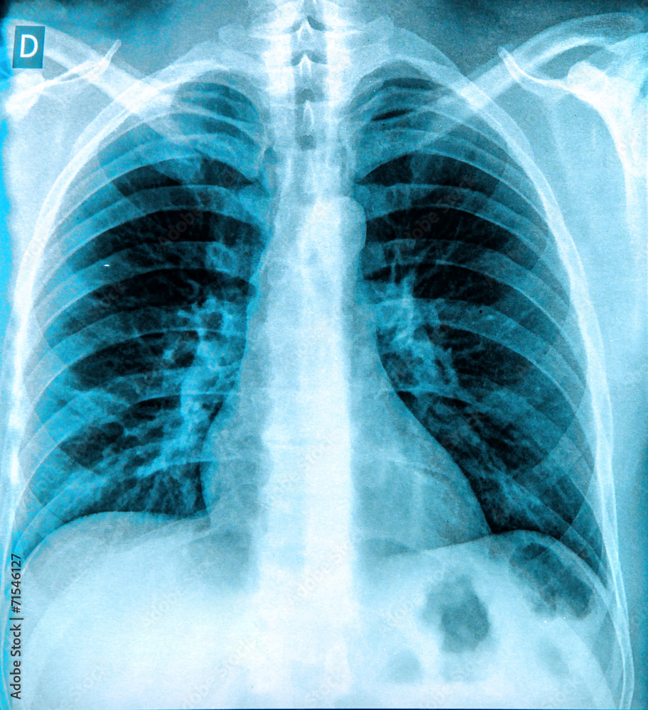 Chest X-ray Image Stock Photo | Adobe Stock
