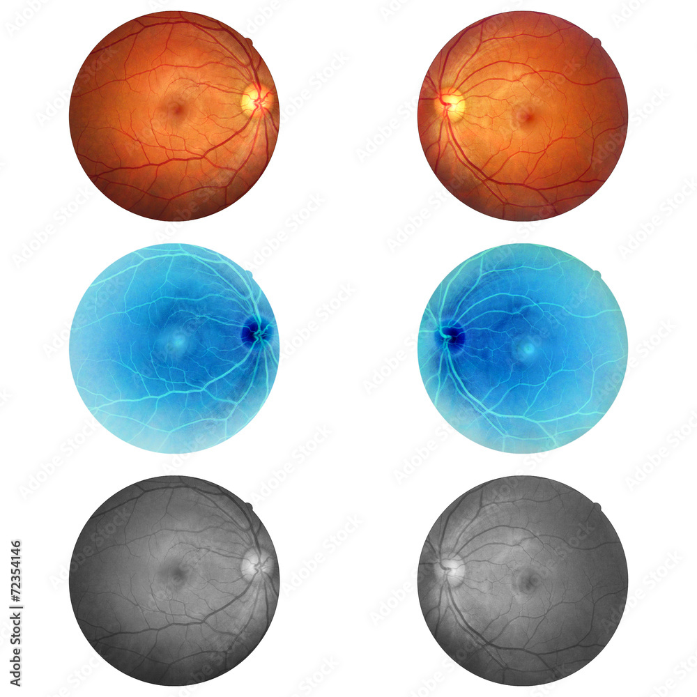 Human eye anatomy, retina, optic disc artery and vein etc. Stock Photo ...