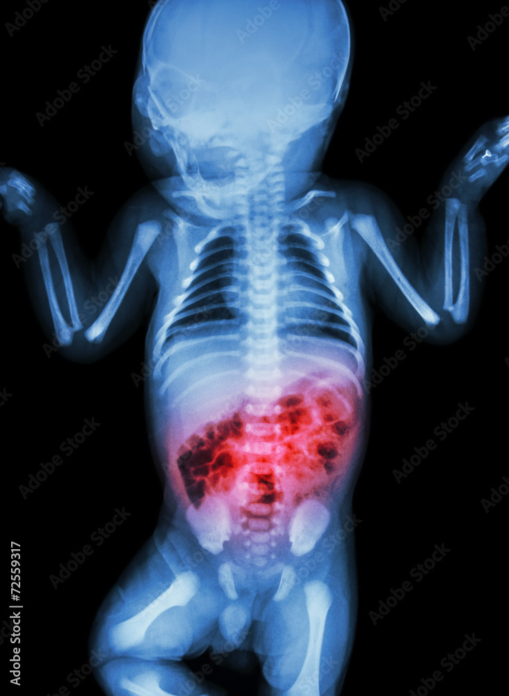 Enteritis (X-ray of sick infant and inflammation of intestine) Stock ...